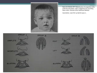 Prosthodontic management of cleft lip and palate | PPTX