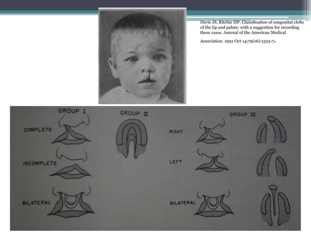 Prosthodontic management of cleft lip and palate | PPTX | Ear, Nose and Throat Conditions ...