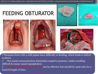 Prosthodontic management of cleft lip and palate | PPTX