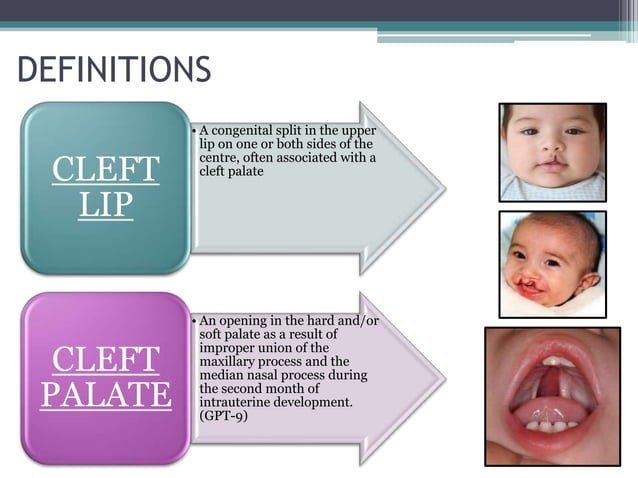 Prosthodontic management of cleft lip and palate | PPTX | Ear, Nose and Throat Conditions ...