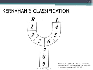 Prosthodontic management of cleft lip and palate | PPT