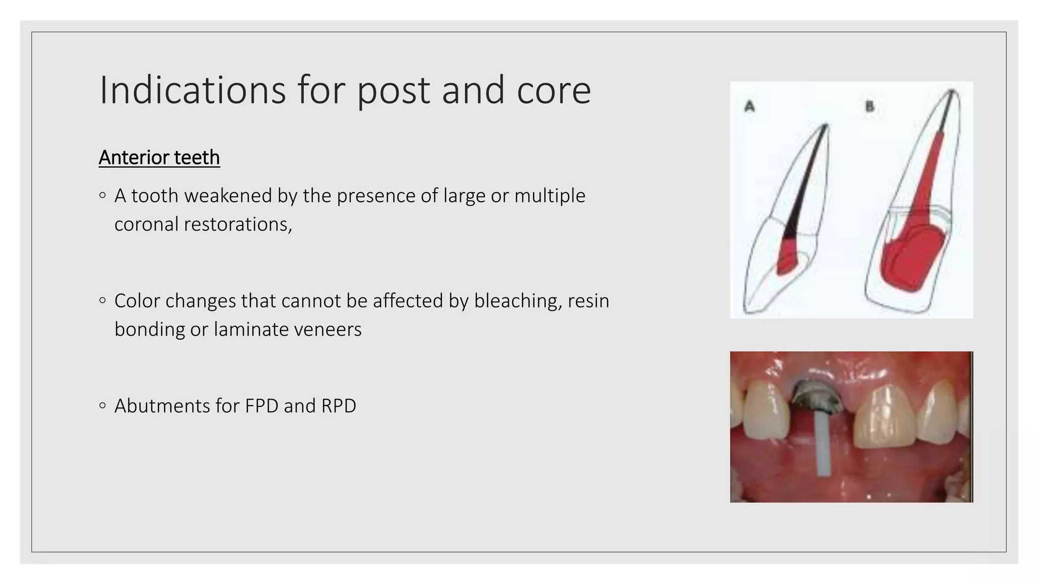 Prosthodontic management of endodontically treated teeth [autosaved] | PPTX