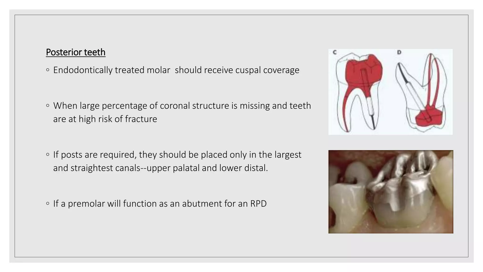 Prosthodontic management of endodontically treated teeth [autosaved] | PPTX