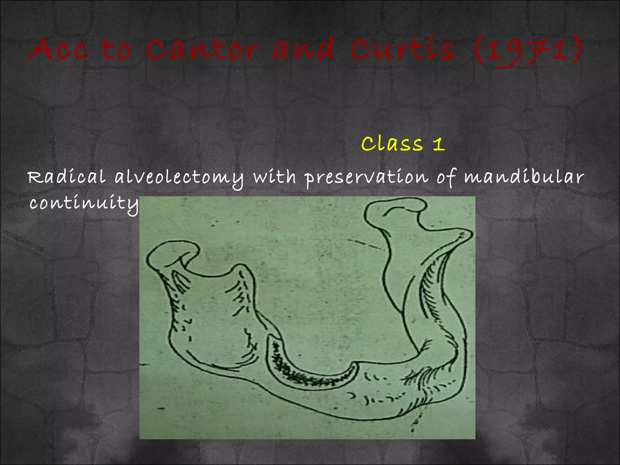 Prosthodontic Management of Mandibular Defects | PPT