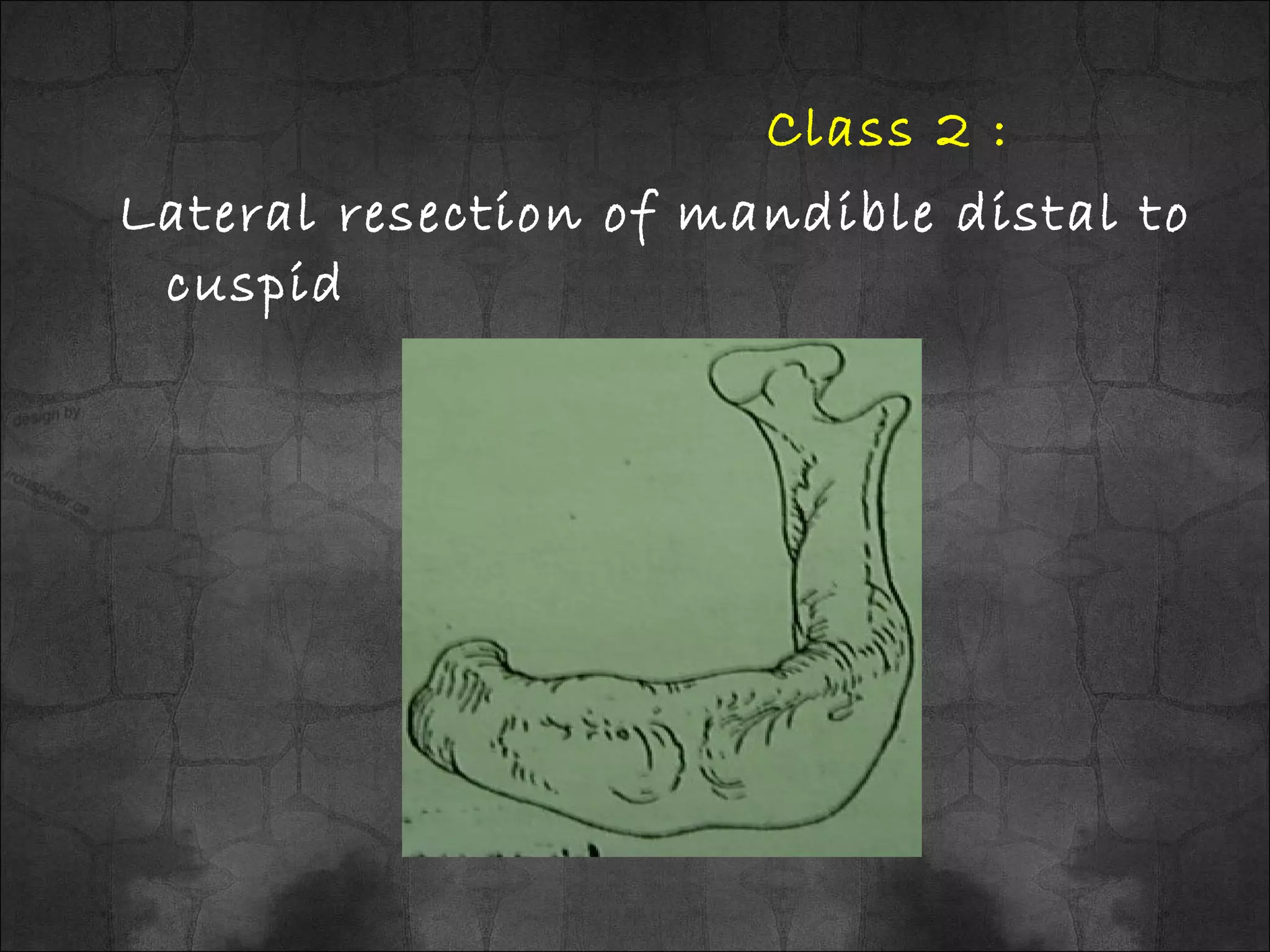 Prosthodontic Management of Mandibular Defects | PPT