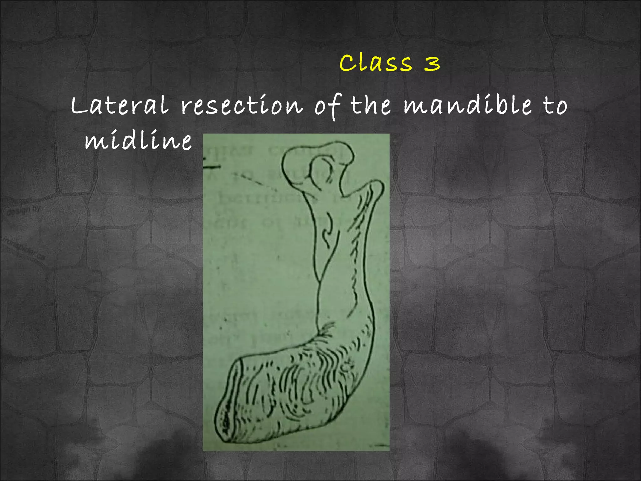 Prosthodontic Management of Mandibular Defects | PPT