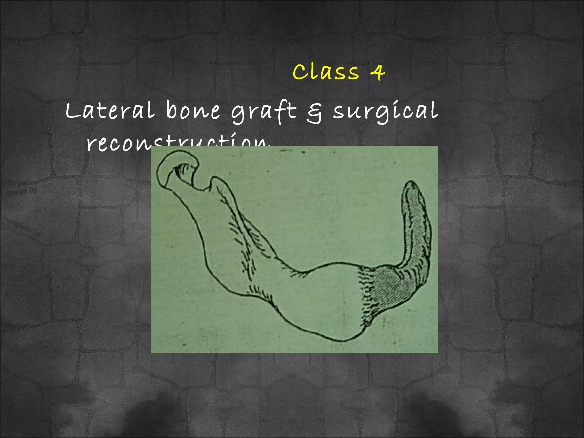 Prosthodontic Management of Mandibular Defects | PPT