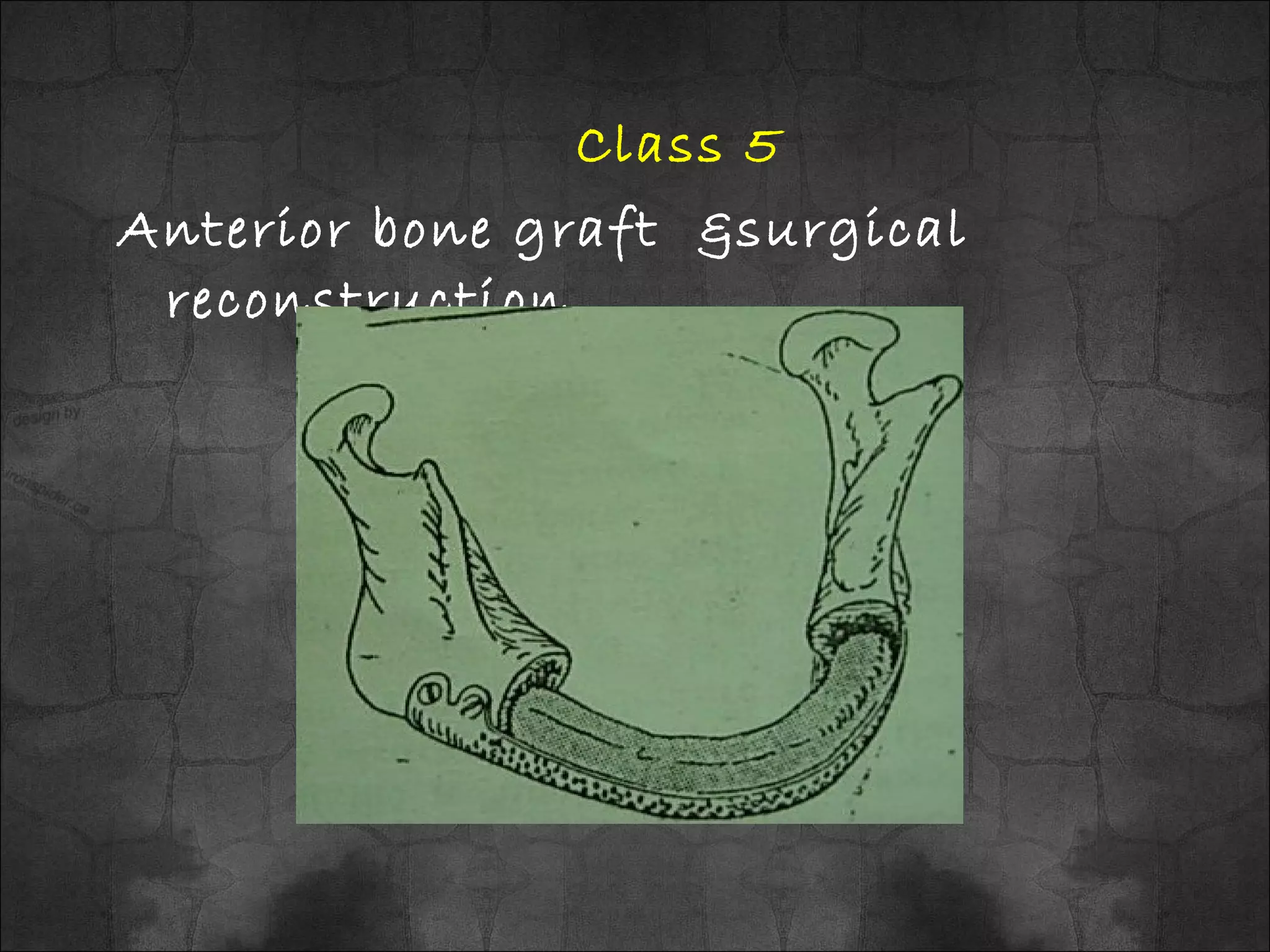 Prosthodontic Management of Mandibular Defects | PPT