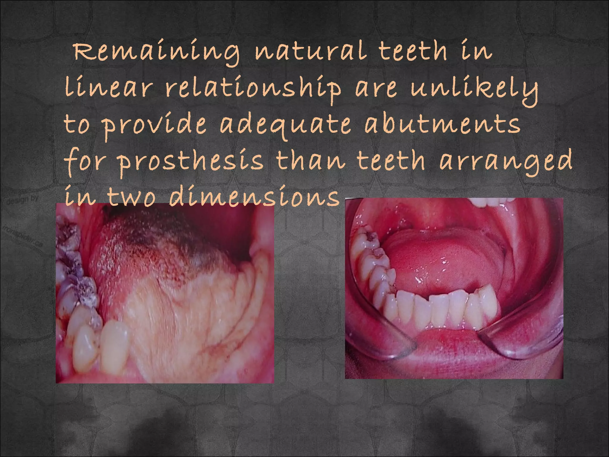 Prosthodontic Management of Mandibular Defects | PPT