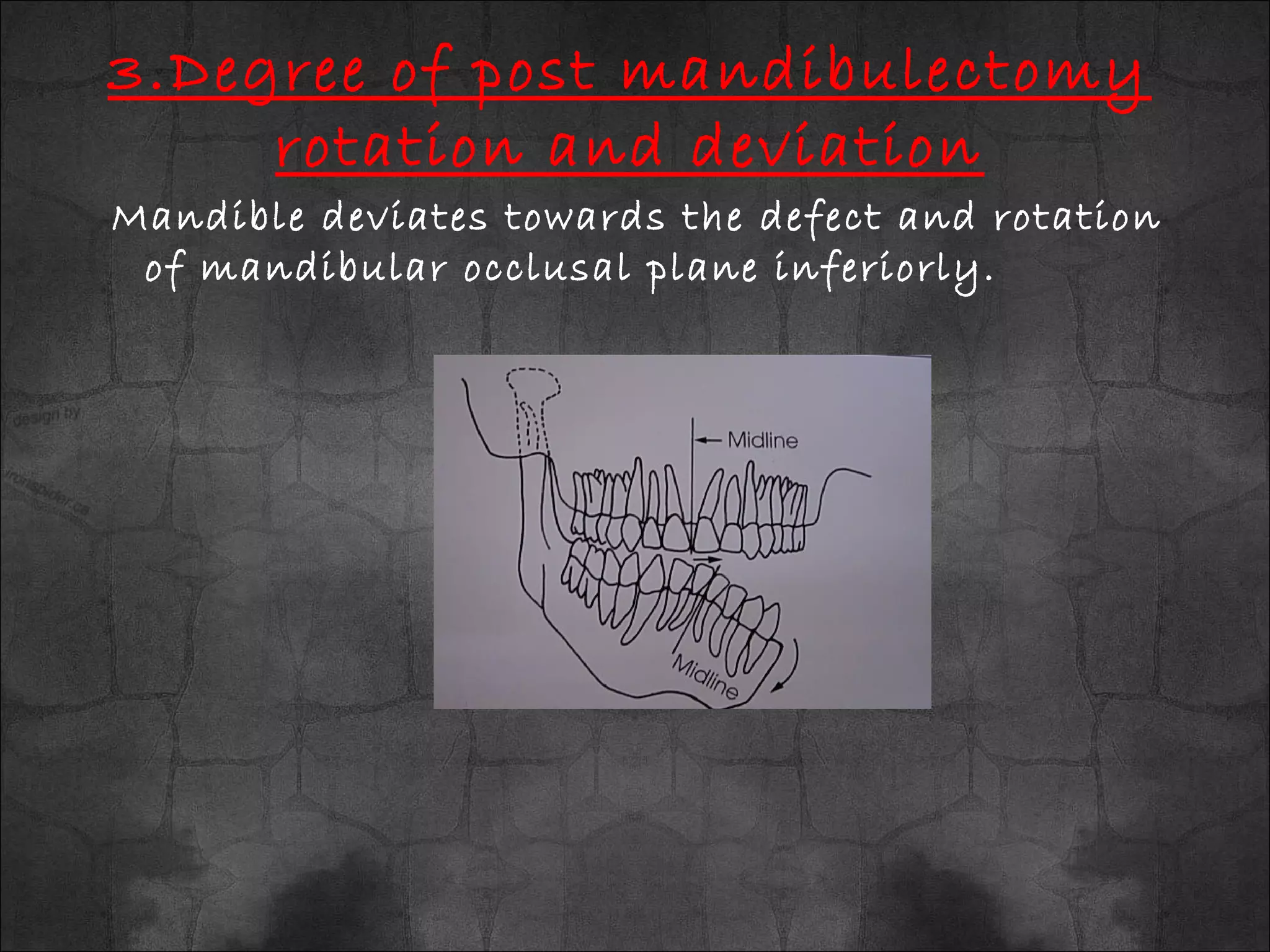 Prosthodontic Management of Mandibular Defects | PPT