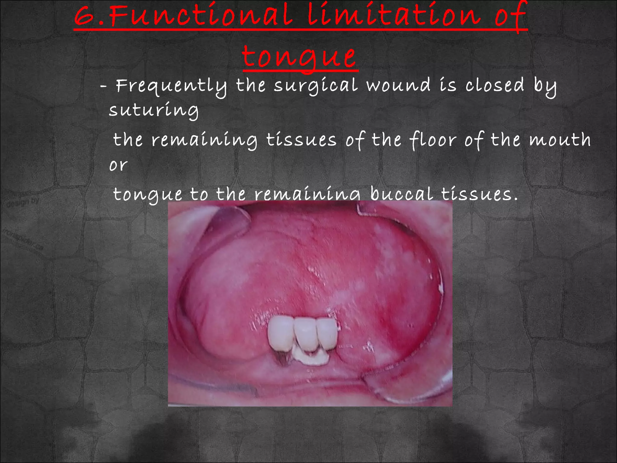 Prosthodontic Management of Mandibular Defects | PPT