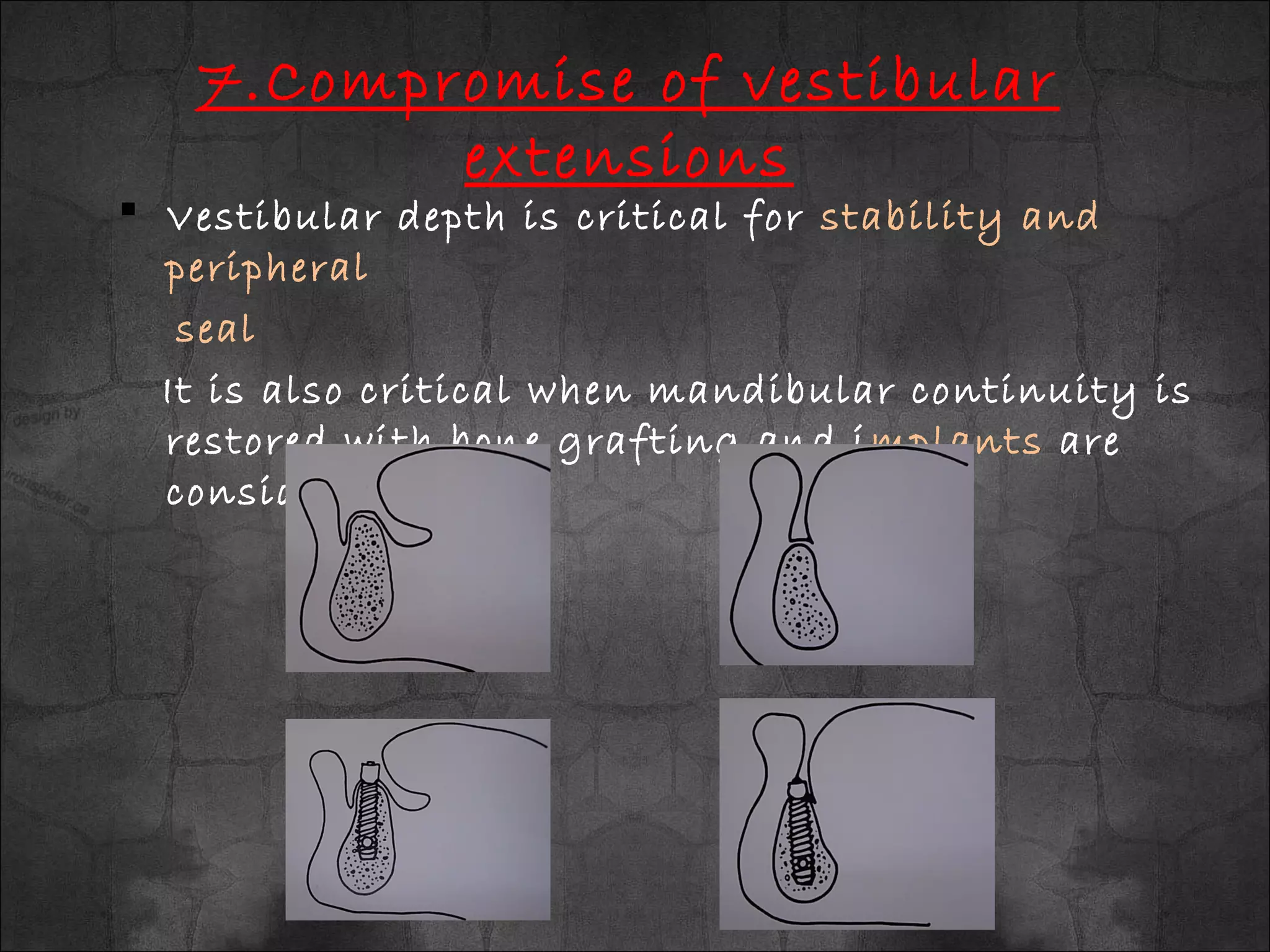 Prosthodontic Management of Mandibular Defects | PPT