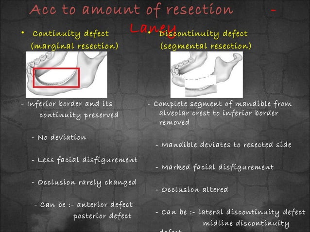 Prosthodontic Management of Mandibular Defects | PPT