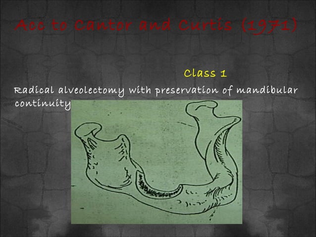 Prosthodontic Management of Mandibular Defects | PPT