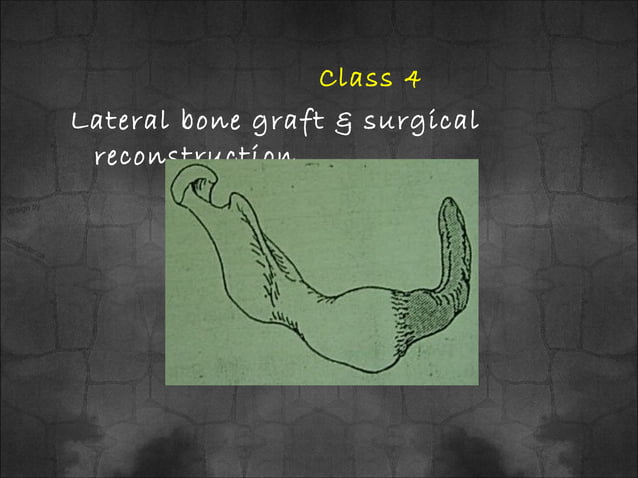 Prosthodontic Management of Mandibular Defects | PPT