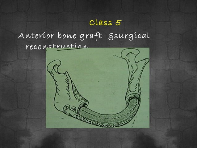 Prosthodontic Management of Mandibular Defects | PPT