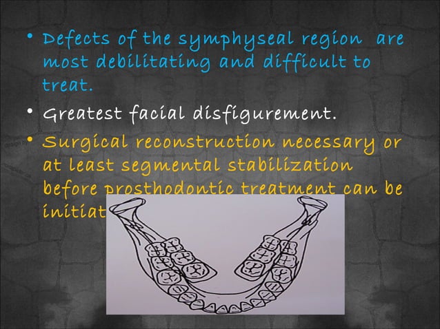 Prosthodontic Management of Mandibular Defects | PPT