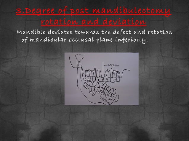 Prosthodontic Management of Mandibular Defects | PPT