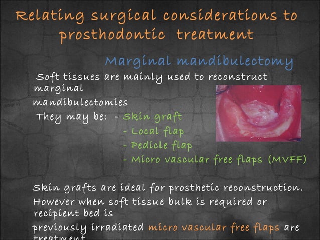 Prosthodontic Management of Mandibular Defects | PPT