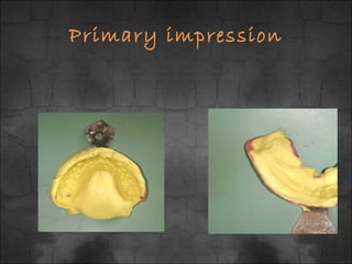 Prosthodontic Management of Mandibular Defects | PPT