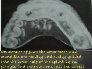 Prosthodontic Management of Mandibular Defects | PPT