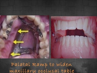 Prosthodontic Management of Mandibular Defects | PPT
