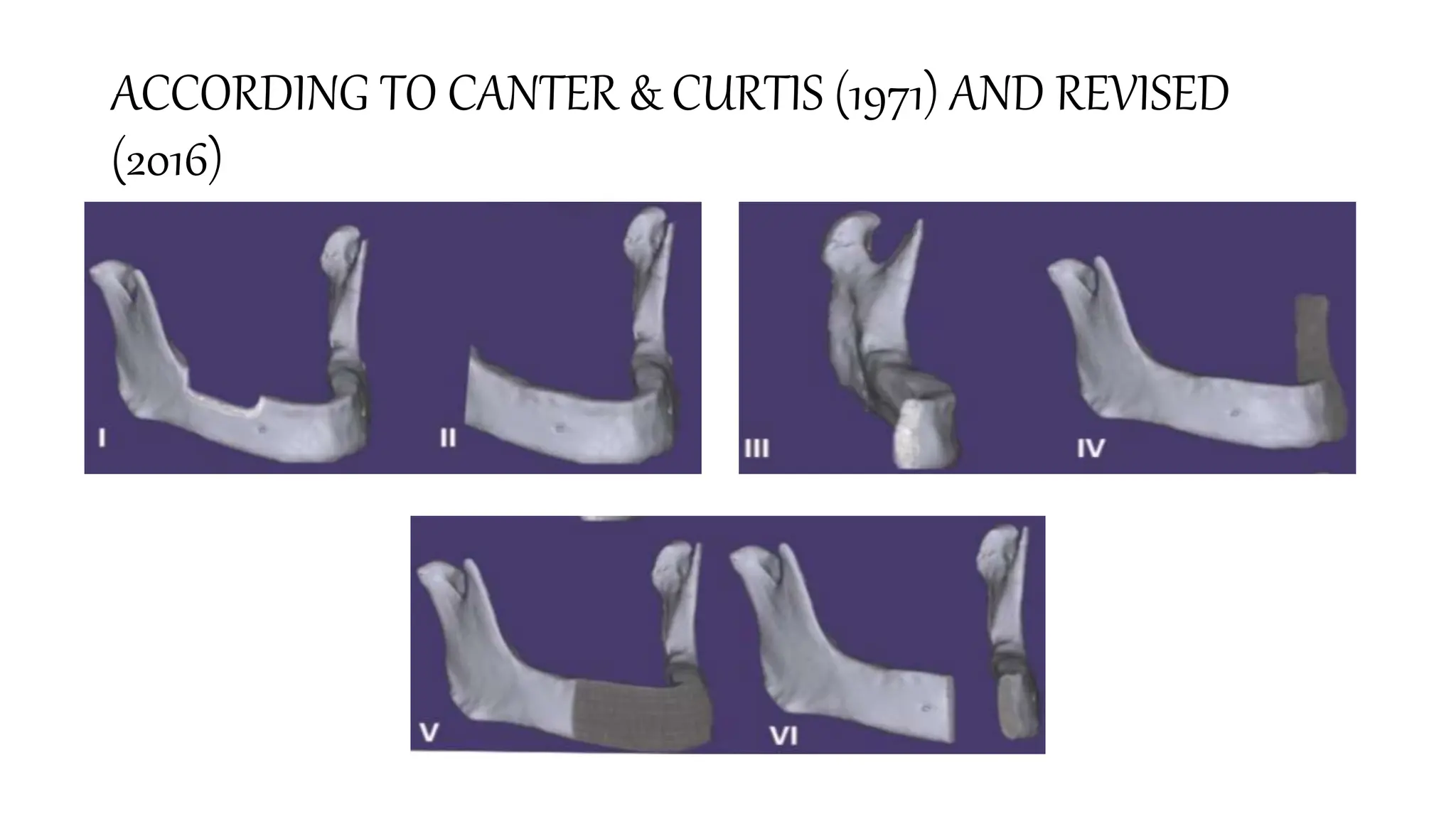 PROSTHODONTIC MANAGEMENT OF MANDIBULAR DEFECTS.pptx