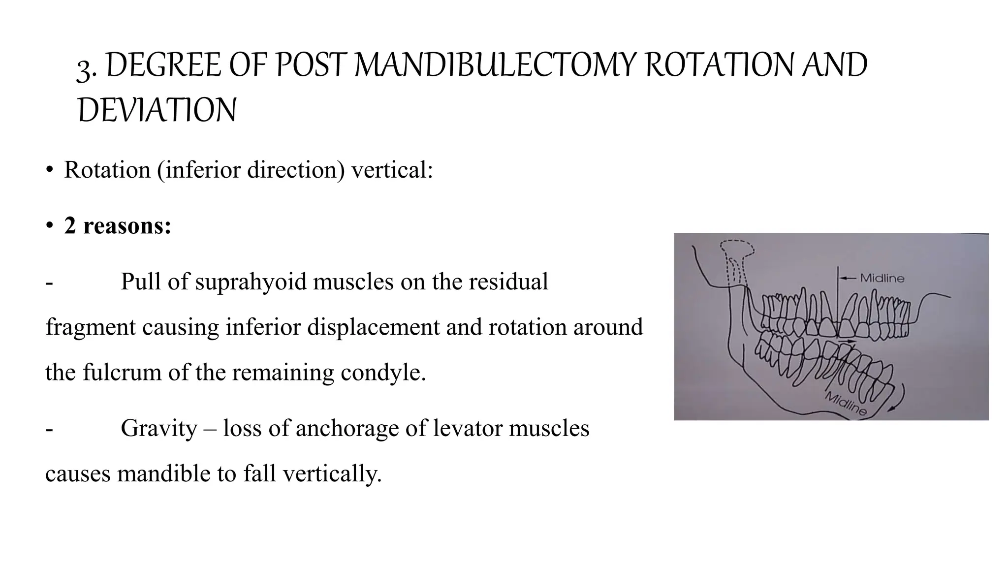 PROSTHODONTIC MANAGEMENT OF MANDIBULAR DEFECTS.pptx
