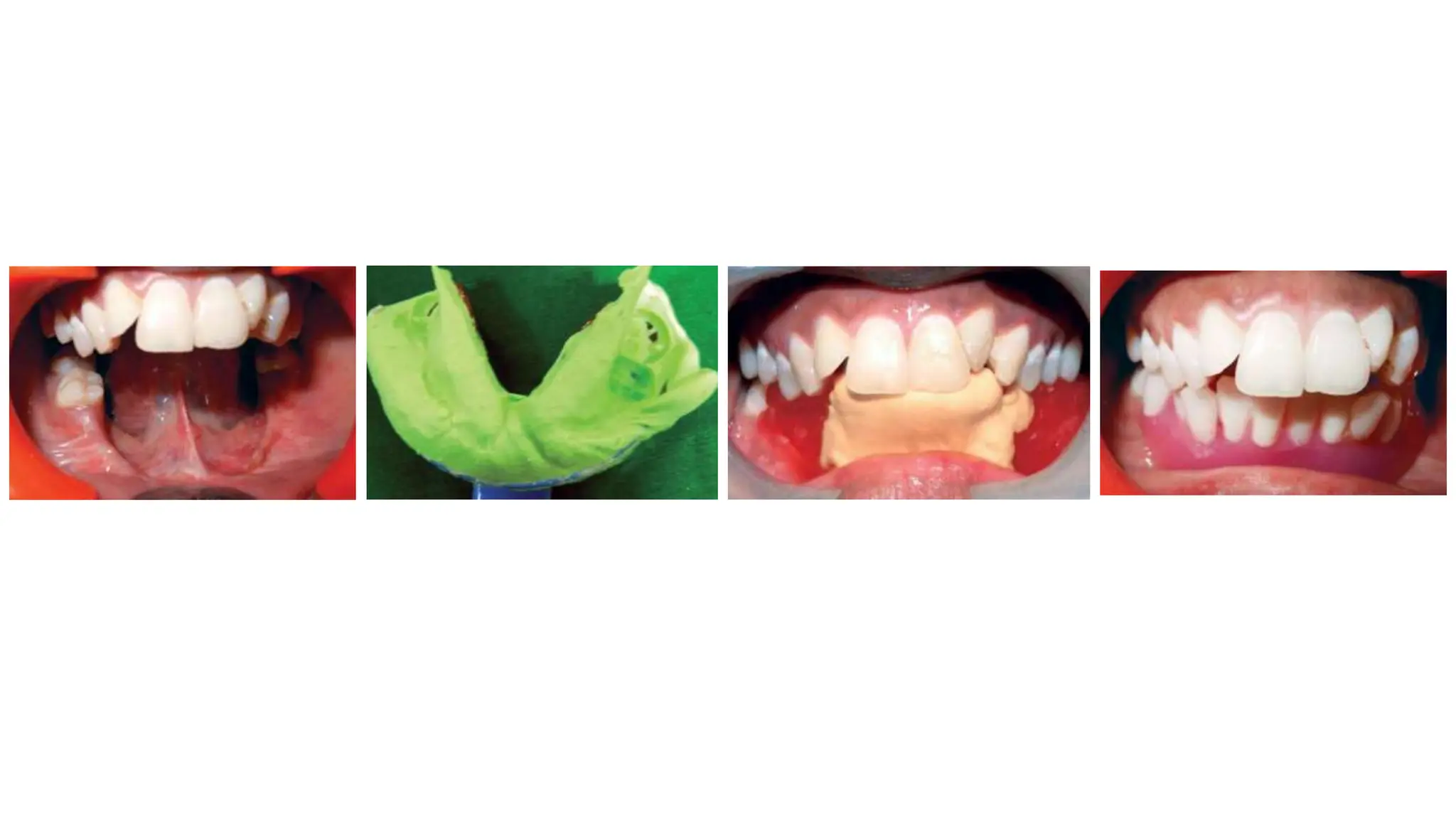 PROSTHODONTIC MANAGEMENT OF MANDIBULAR DEFECTS.pptx