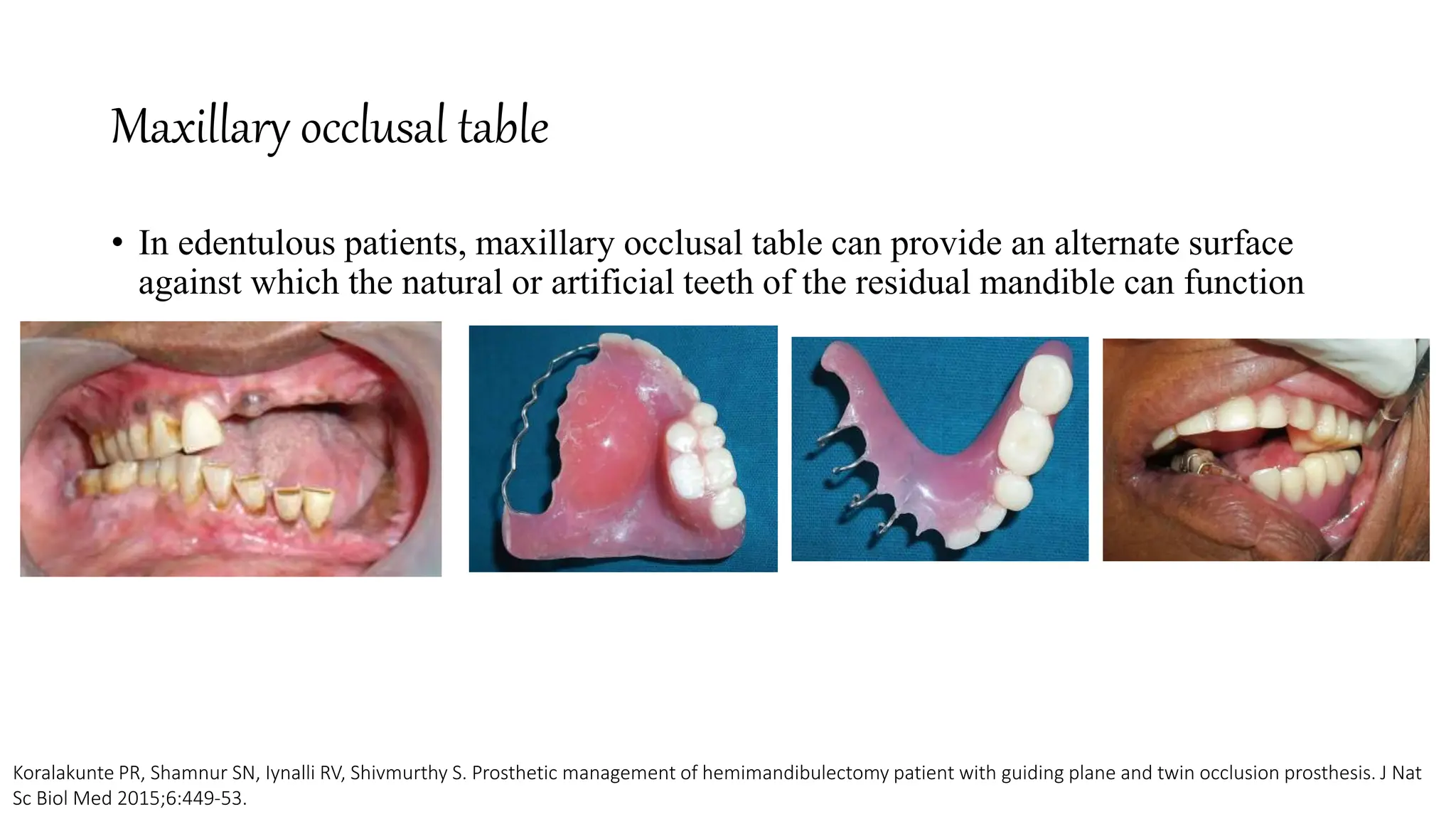 PROSTHODONTIC MANAGEMENT OF MANDIBULAR DEFECTS.pptx