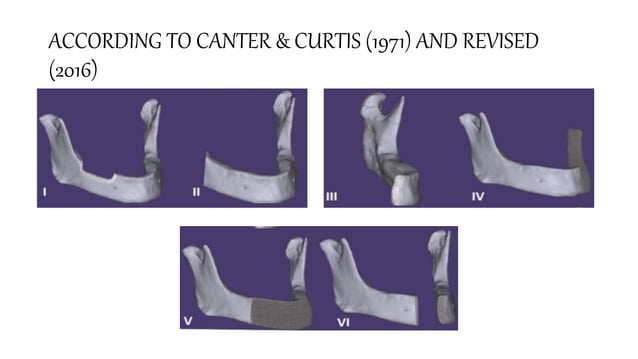 PROSTHODONTIC MANAGEMENT OF MANDIBULAR DEFECTS.pptx | Ear, Nose and ...