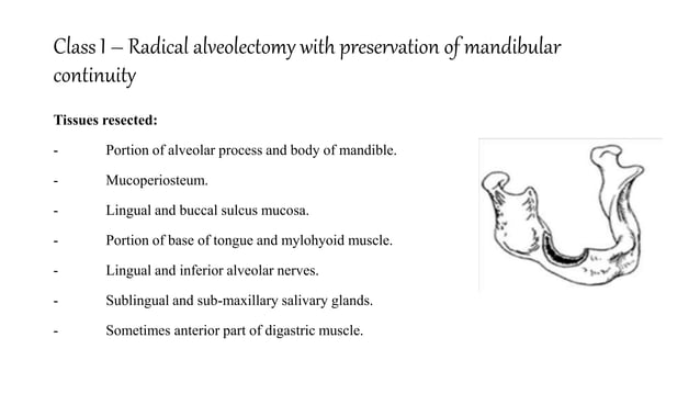 PROSTHODONTIC MANAGEMENT OF MANDIBULAR DEFECTS.pptx | Ear, Nose and ...