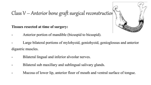 PROSTHODONTIC MANAGEMENT OF MANDIBULAR DEFECTS.pptx | Ear, Nose and ...
