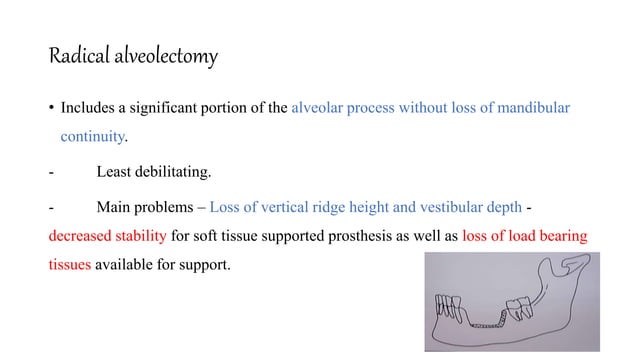 PROSTHODONTIC MANAGEMENT OF MANDIBULAR DEFECTS.pptx | Ear, Nose and ...