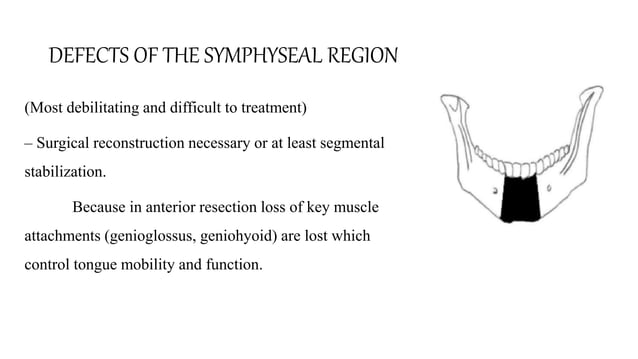 PROSTHODONTIC MANAGEMENT OF MANDIBULAR DEFECTS.pptx | Ear, Nose and ...