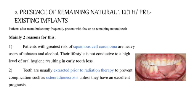 PROSTHODONTIC MANAGEMENT OF MANDIBULAR DEFECTS.pptx | Ear, Nose and ...