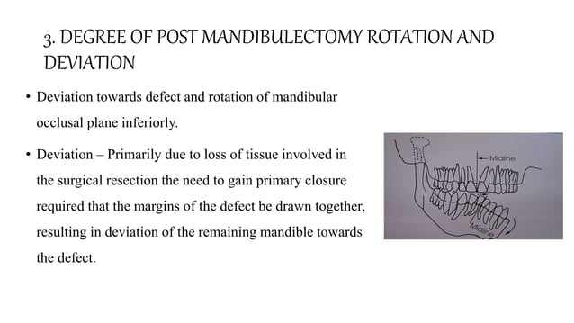PROSTHODONTIC MANAGEMENT OF MANDIBULAR DEFECTS.pptx | Ear, Nose and ...