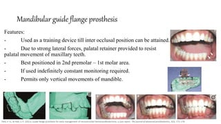 PROSTHODONTIC MANAGEMENT OF MANDIBULAR DEFECTS.pptx