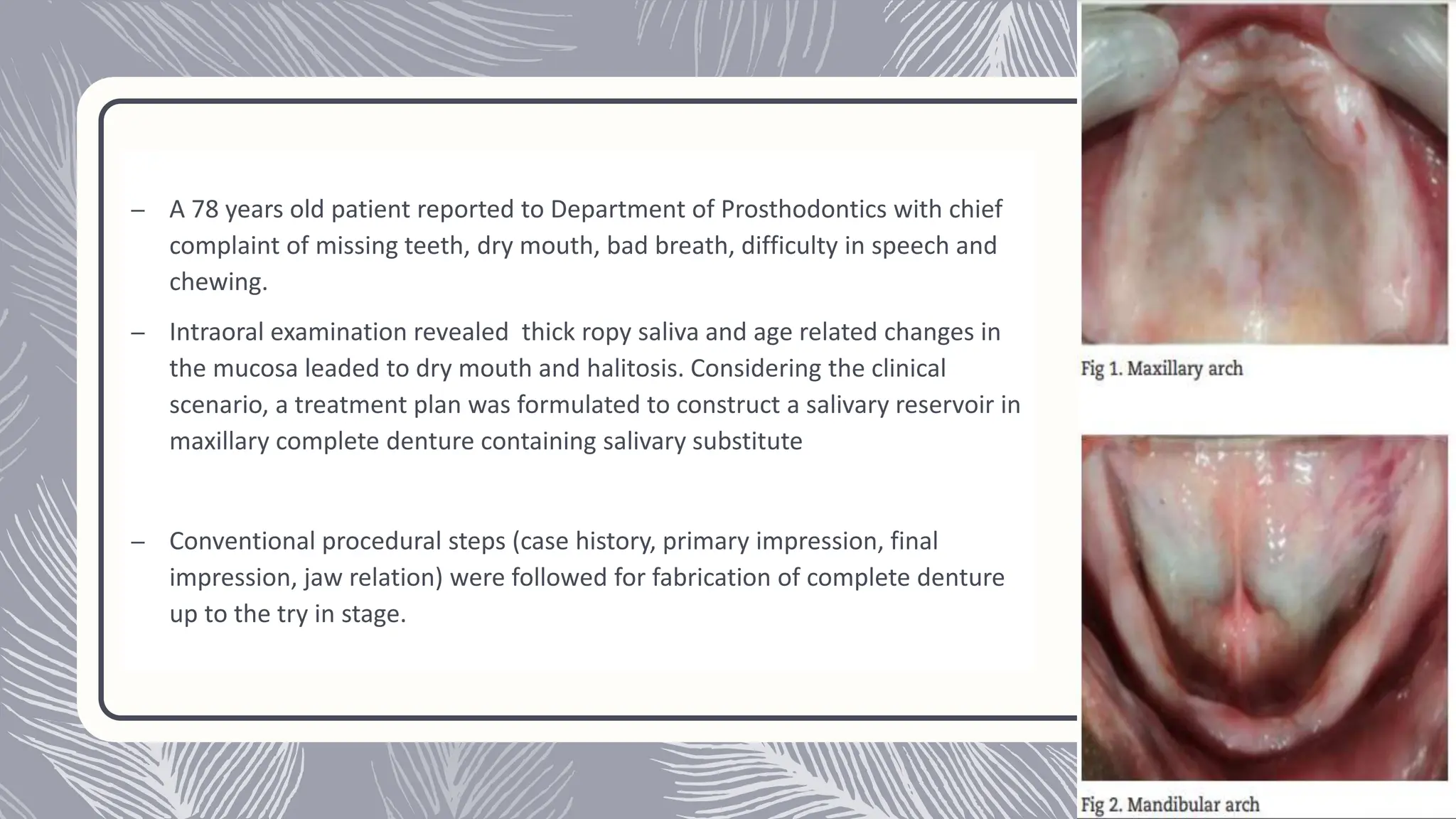 Prosthodontic Management of Xerostomia.pptx