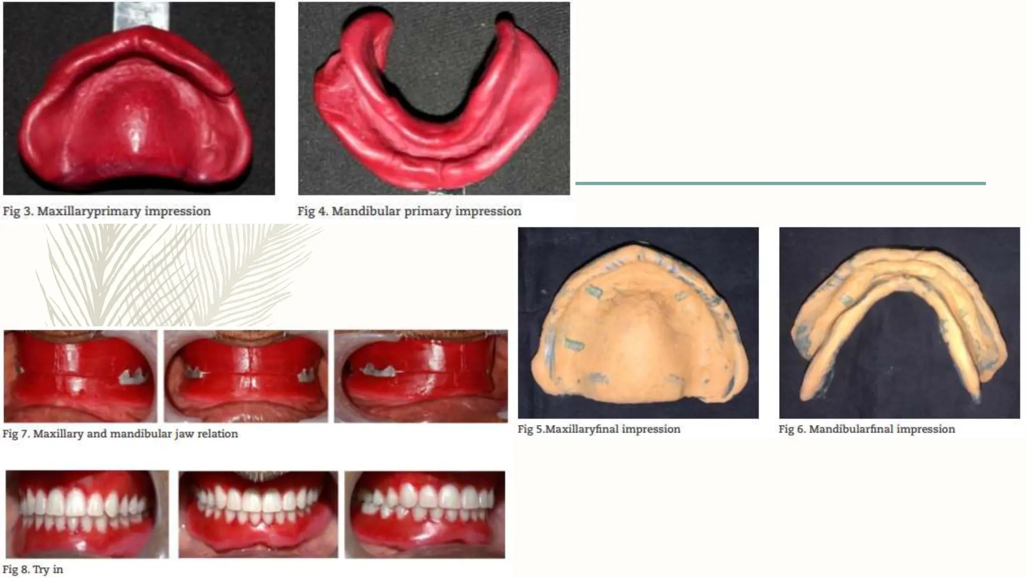 Prosthodontic Management of Xerostomia.pptx