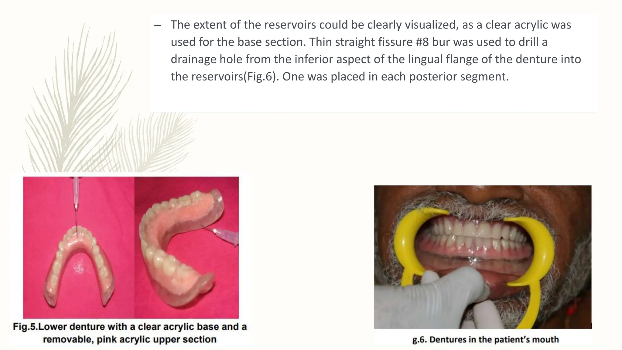 Prosthodontic Management of Xerostomia.pptx
