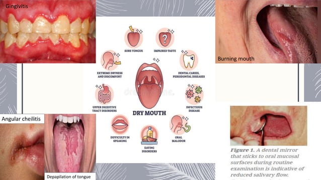 Prosthodontic Management of Xerostomia.pptx