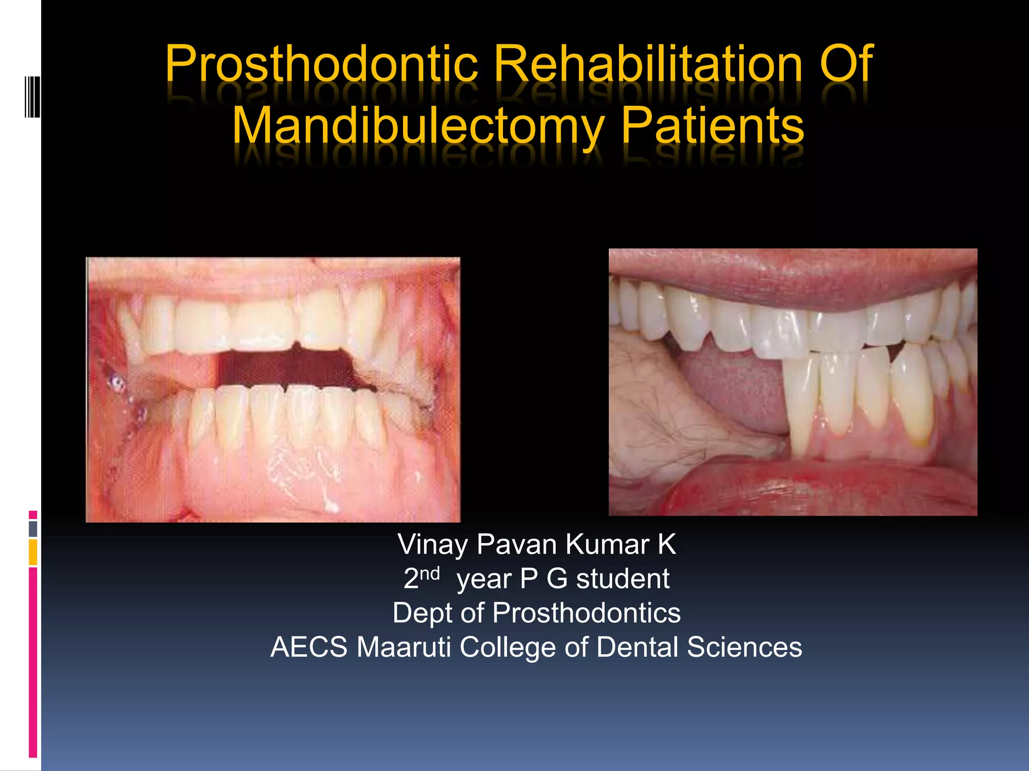 Prosthodontic rehabilitation of mandibulectomy | PPTX