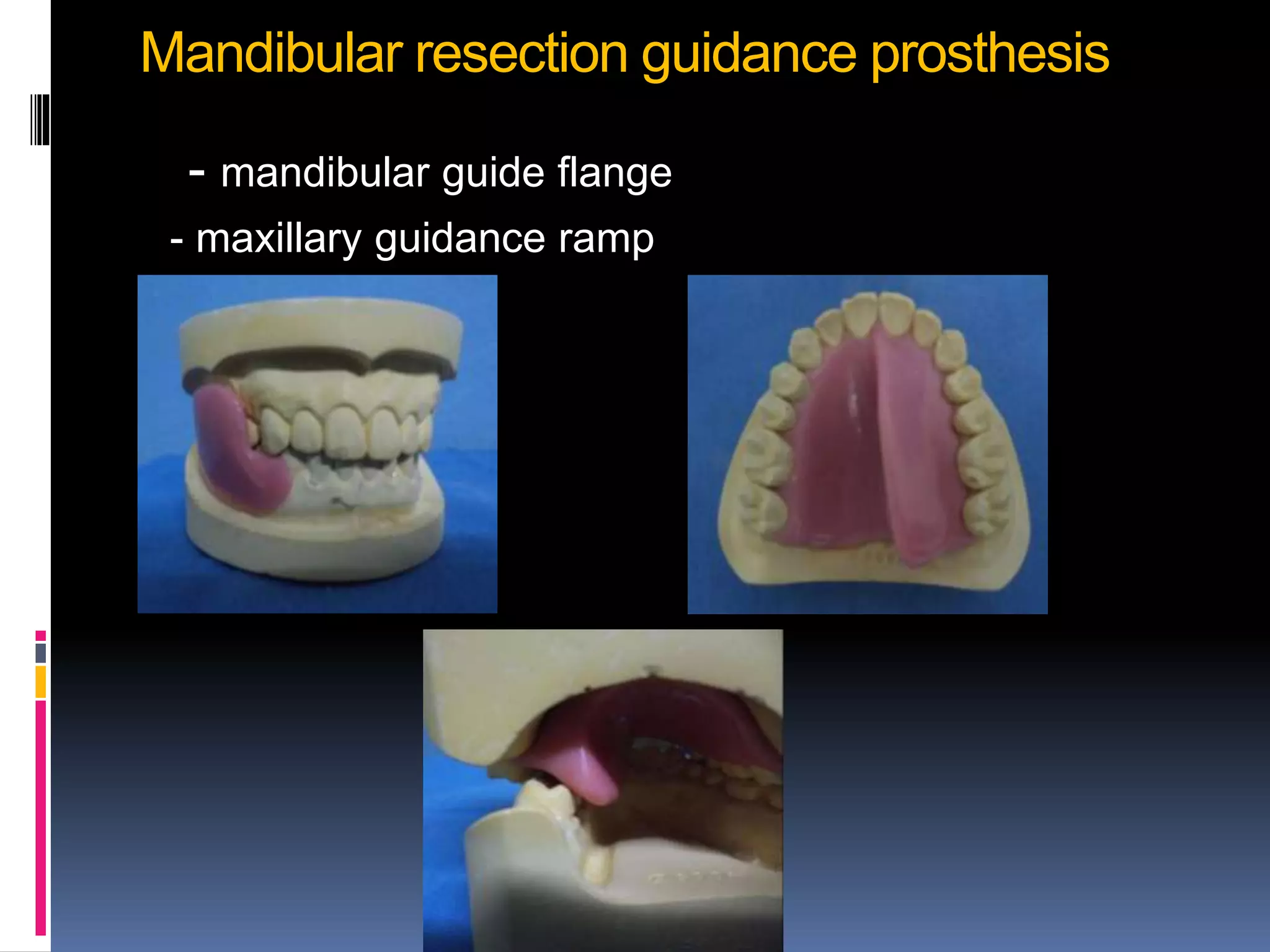 Prosthodontic rehabilitation of mandibulectomy | PPTX