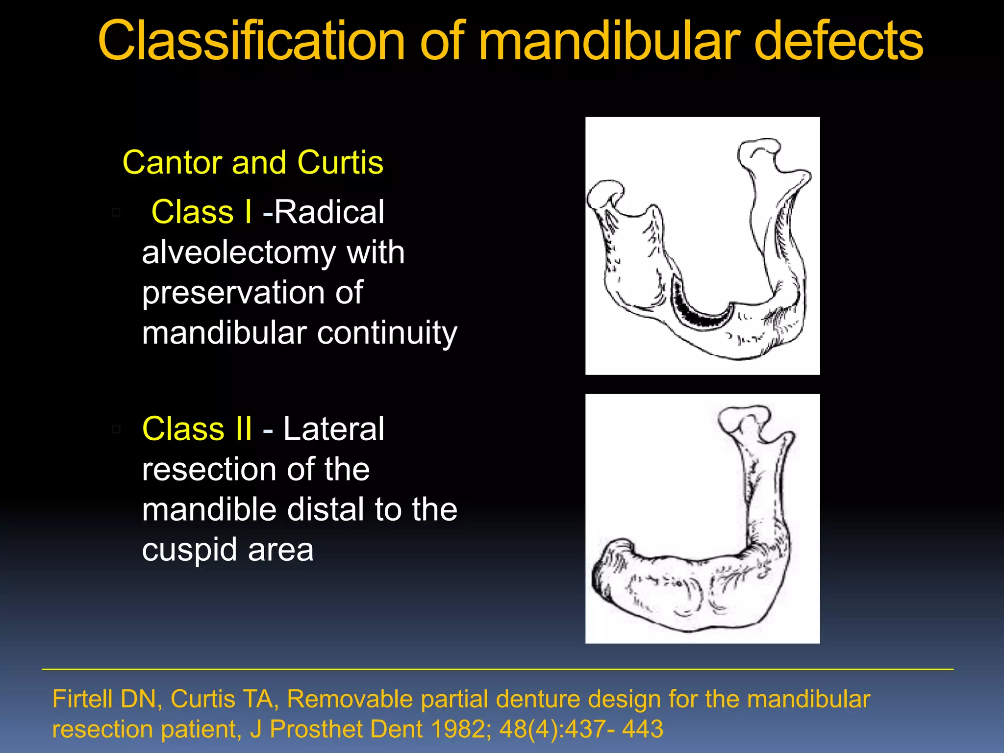 Prosthodontic rehabilitation of mandibulectomy | PPTX