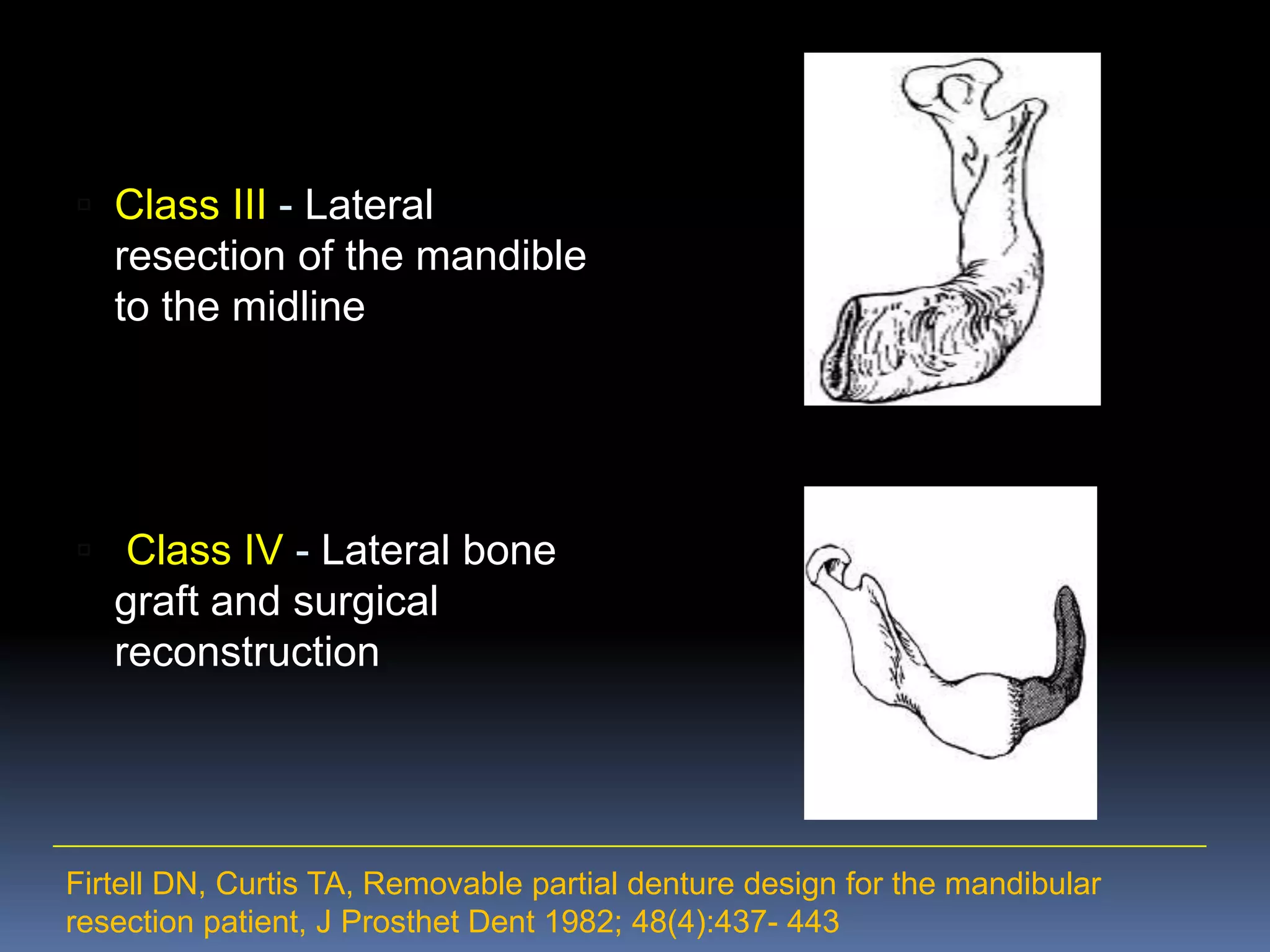 Prosthodontic rehabilitation of mandibulectomy | PPTX
