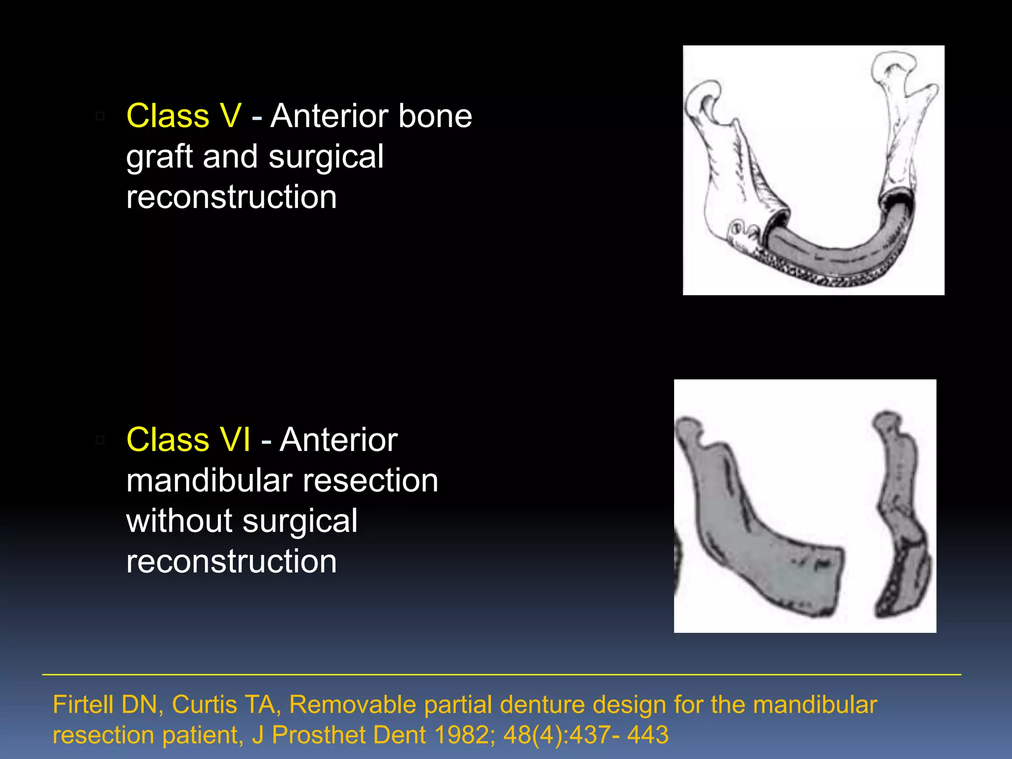 Prosthodontic rehabilitation of mandibulectomy | PPTX