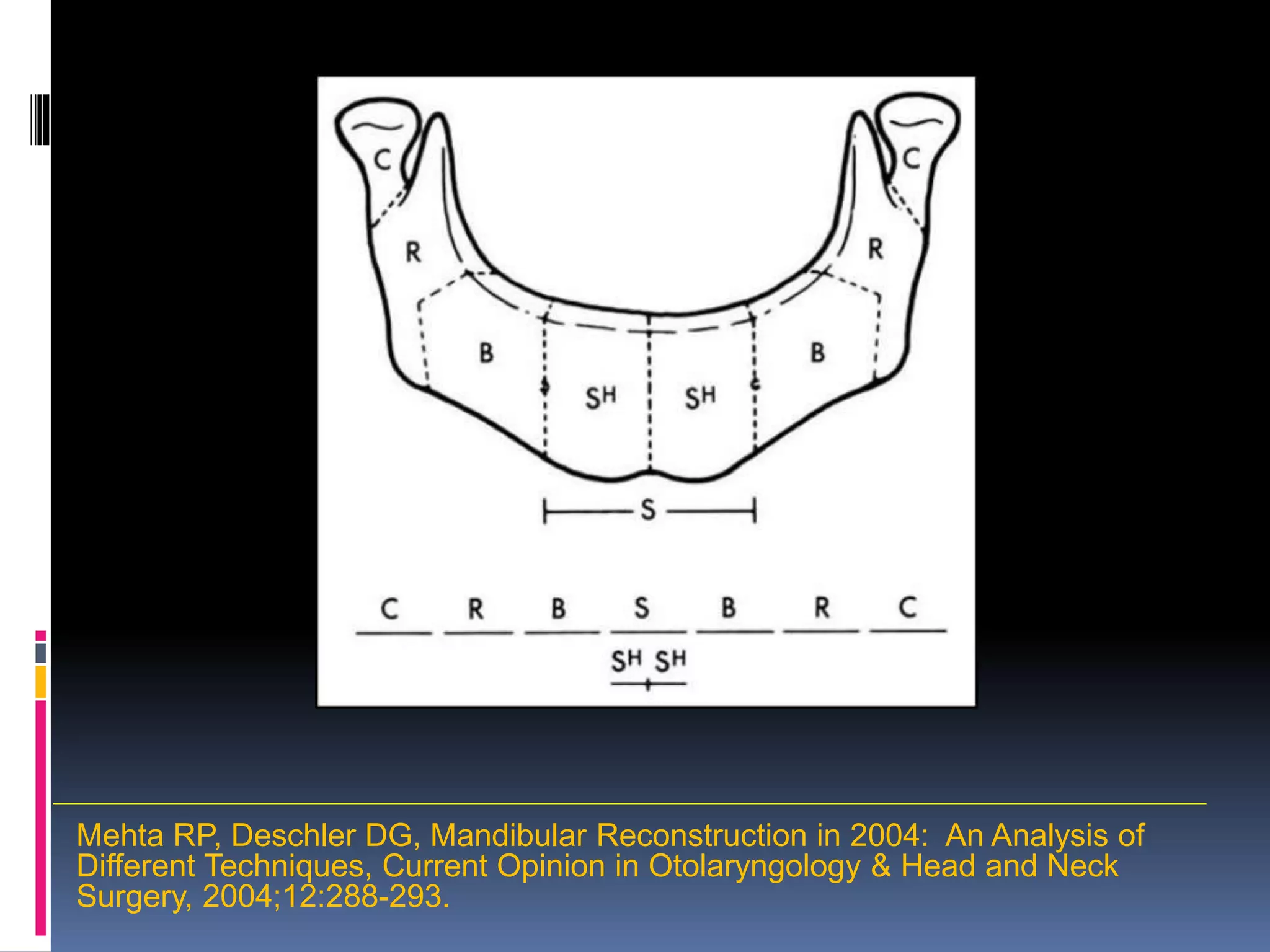 Prosthodontic rehabilitation of mandibulectomy | PPTX