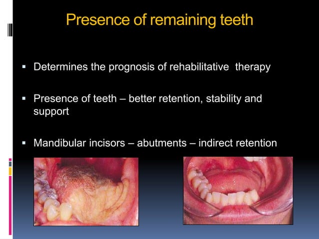 Prosthodontic rehabilitation of mandibulectomy | PPTX
