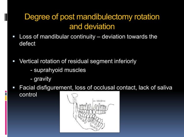 Prosthodontic rehabilitation of mandibulectomy | PPTX